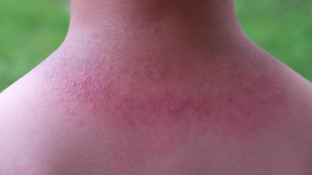 The 10 Common Skin Rashes and How to Get Rid of Them - Health Makes You